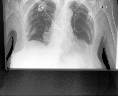 My Awesome Introductory Machine Learning Blog - Determining Race from Chest X-Rays